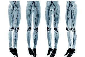 Buerger Disease – Dr Kalko